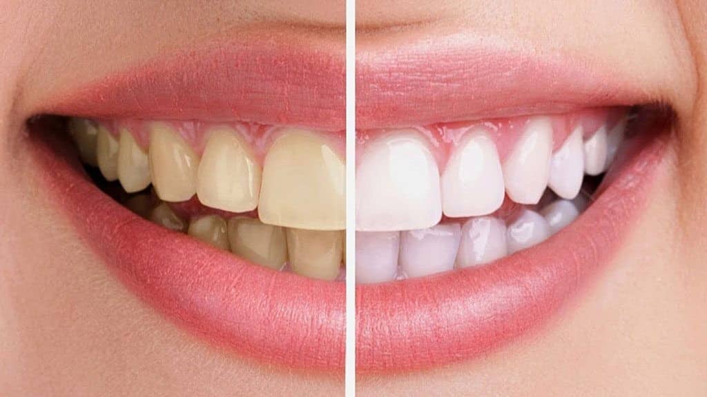 Top 3 Organic Cost-Effective Ways to Whiten Teeth - Beauty Body & Health
